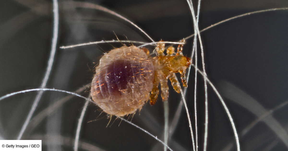 Les poux pourraient aider les scientifiques à retrouver l'ADN de nos ...